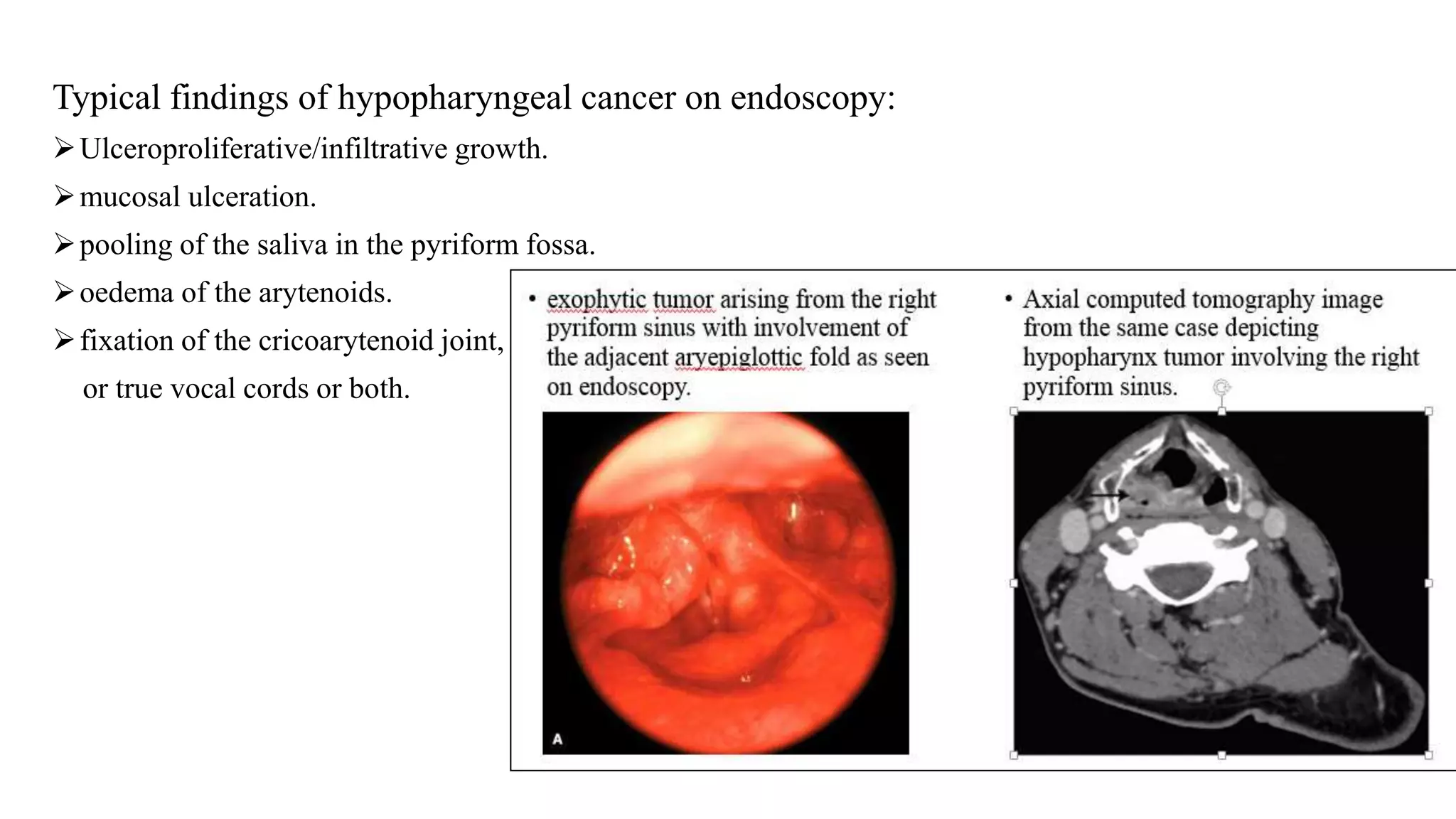 management of carcinoma hypopharynx | PPTX