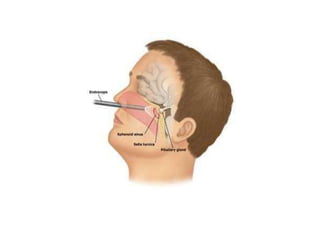 hypophysectomy.pptx