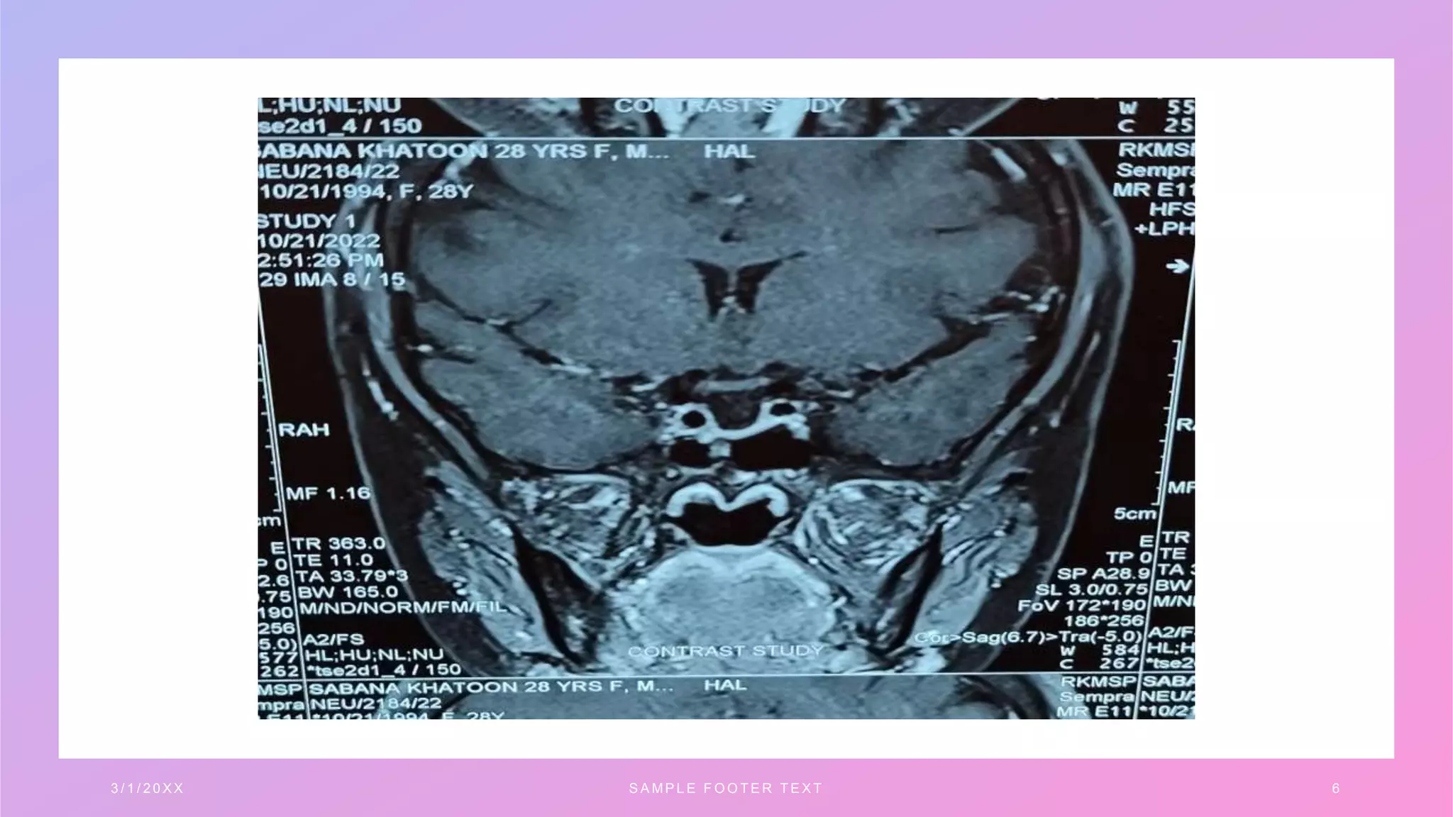 SHEEHAN SYNDROME AND PAN HYPOPITUITARISM - ENDOCRINOLOGY .pptx