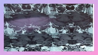 SHEEHAN SYNDROME AND PAN HYPOPITUITARISM - ENDOCRINOLOGY .pptx