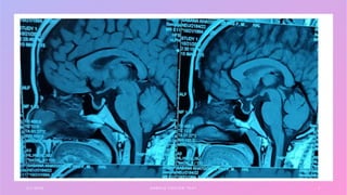 SHEEHAN SYNDROME AND PAN HYPOPITUITARISM - ENDOCRINOLOGY .pptx