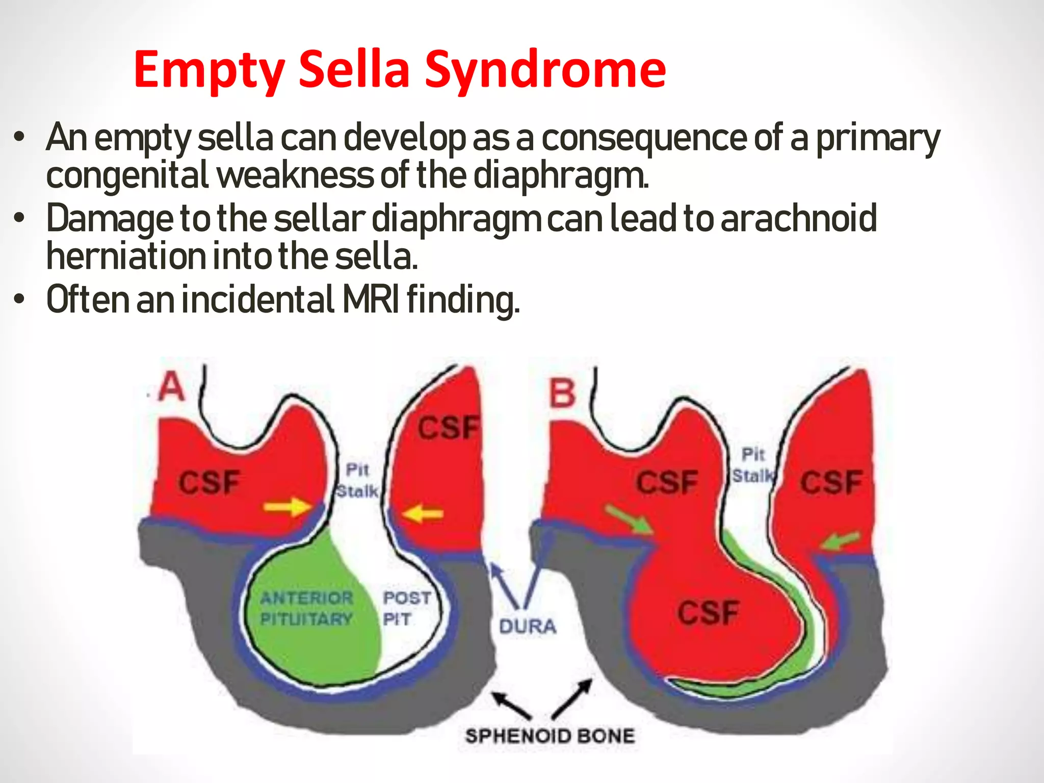 HYPOPITUITARISM.pptx