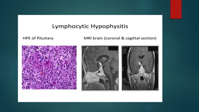 Hypopituitarism power point presentation | PPTX