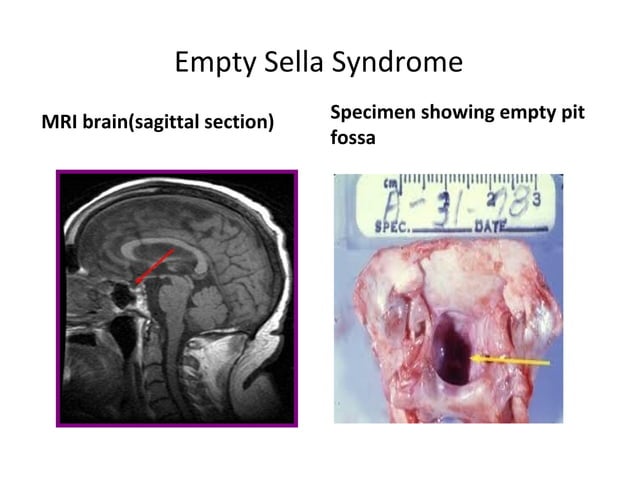 Hypopituitarism diagnosis and management (1) | PPT | Hormonal Disorders ...