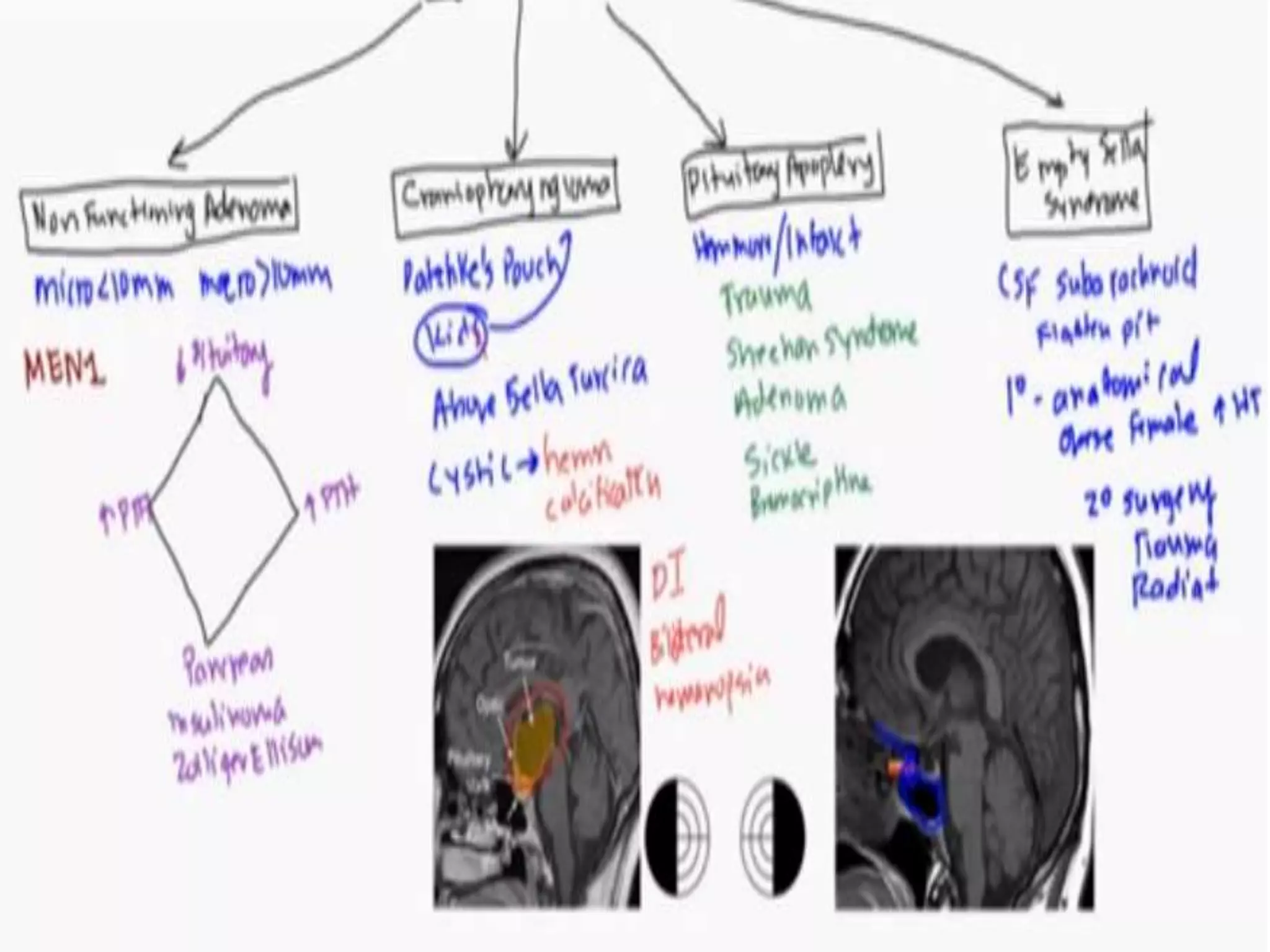 Hypopituitarism complete.pptx