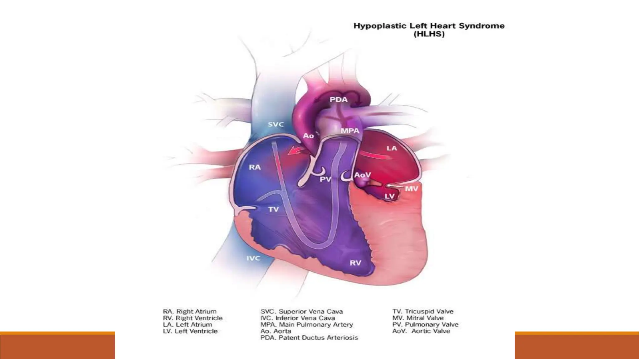 Hypoplastic Left heart dr Alister 3.pptx