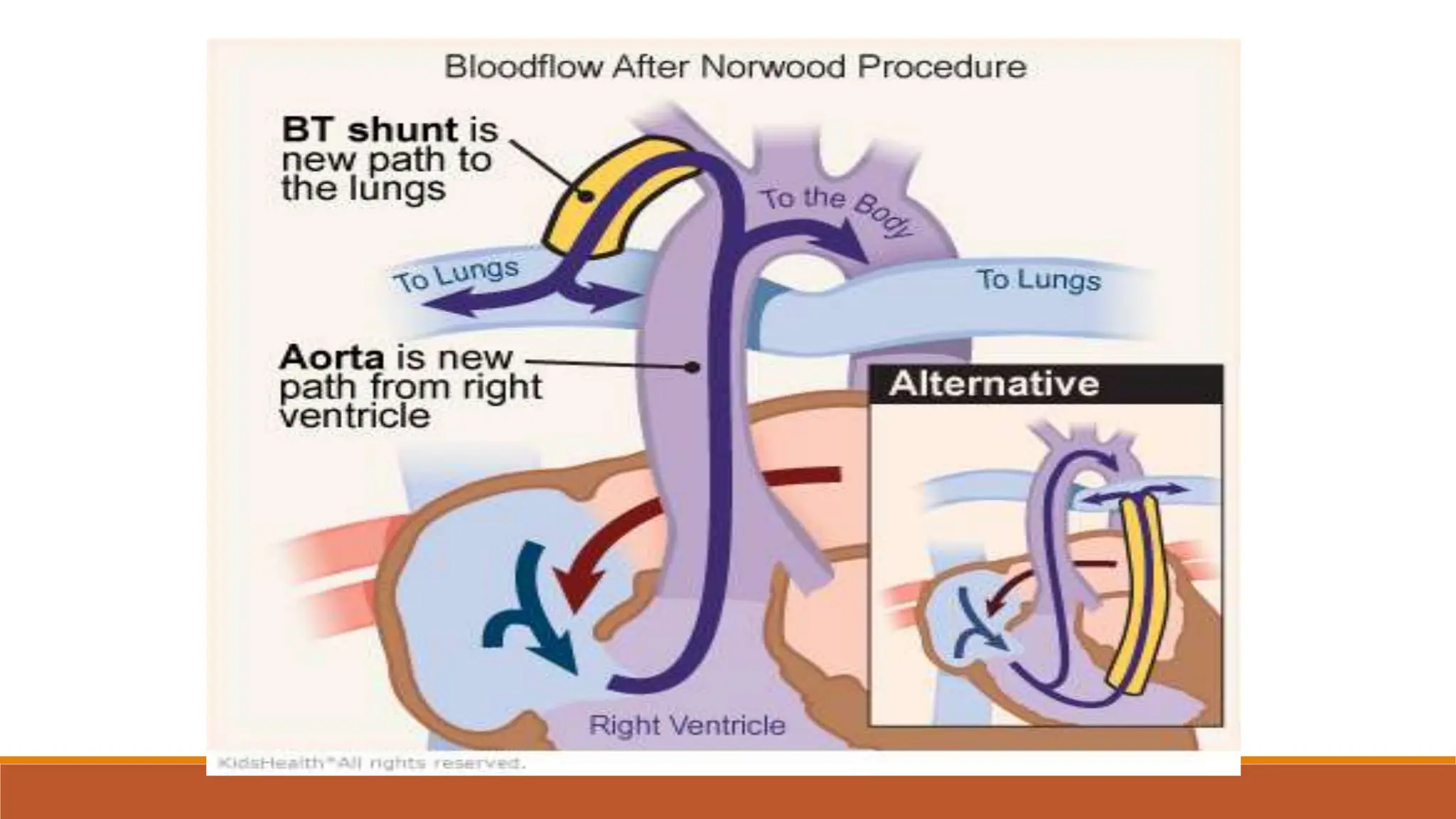 Hypoplastic Left heart dr Alister 3.pptx