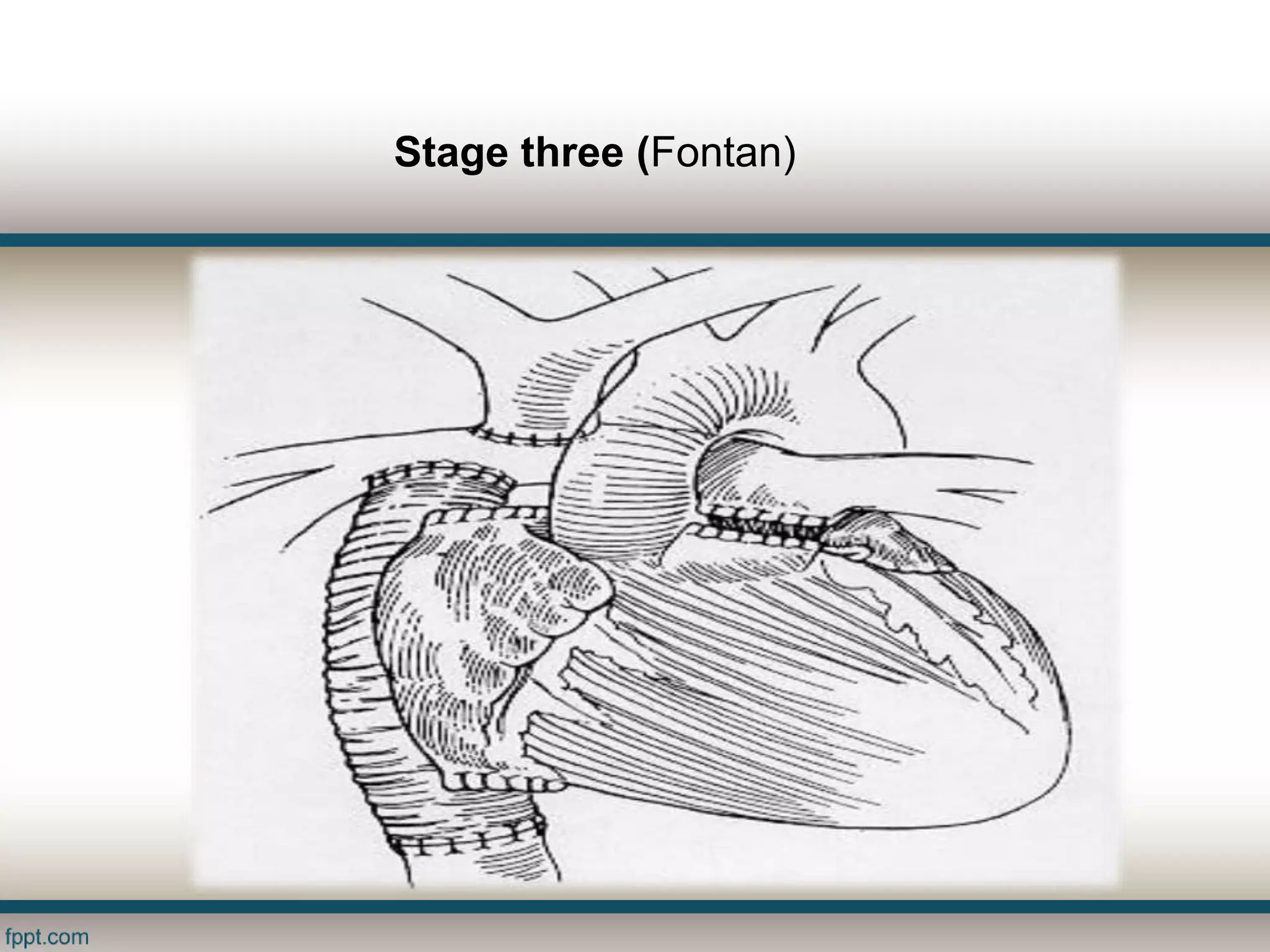 Hypoplastic left heart syndrome Surgical management | PPTX
