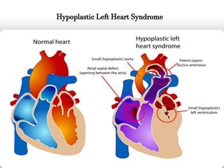 Hypoplastic left heart syndrome Surgical management | PPTX