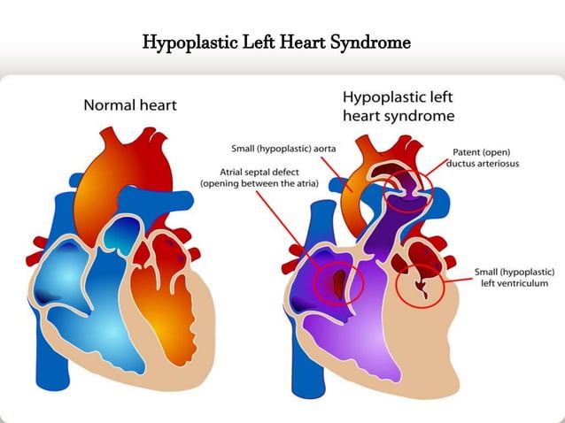 Hypoplastic left heart syndrome Surgical management | PPT