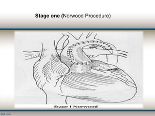 Hypoplastic left heart syndrome Surgical management | PPTX