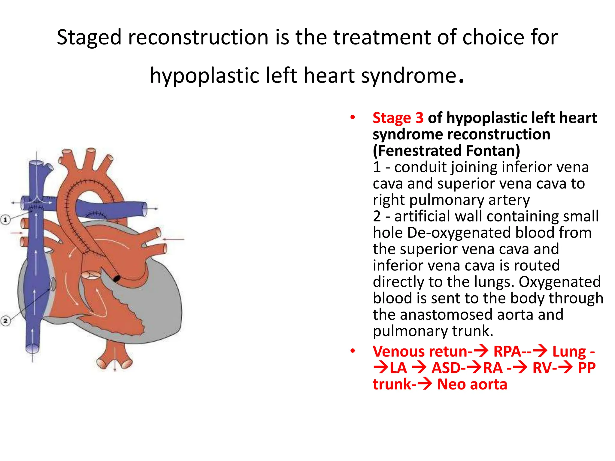 hypoplastic lv.pptx