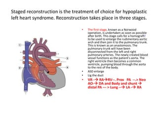 hypoplastic lv.pptx