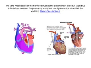 hypoplastic lv.pptx