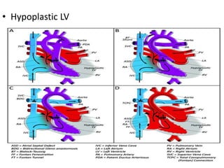 hypoplastic lv.pptx
