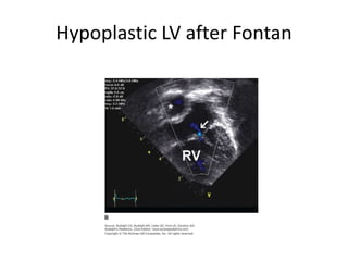 hypoplastic lv.pptx