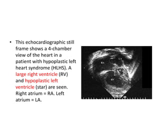 hypoplastic lv.pptx