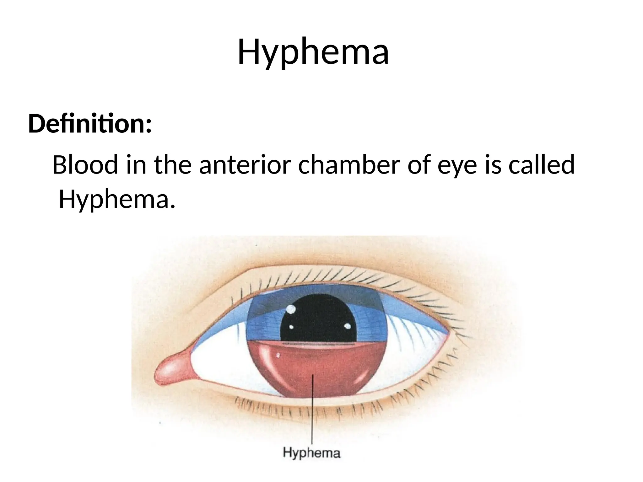 hypopyon vs ................hyphema.pptx
