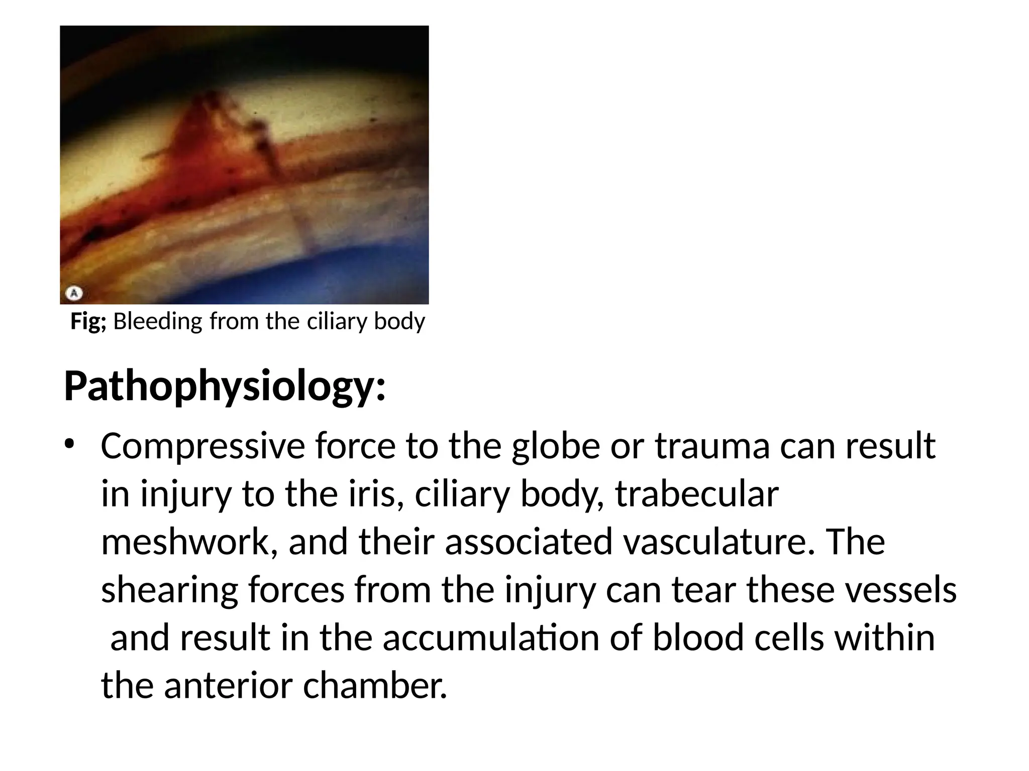 hypopyon vs ................hyphema.pptx