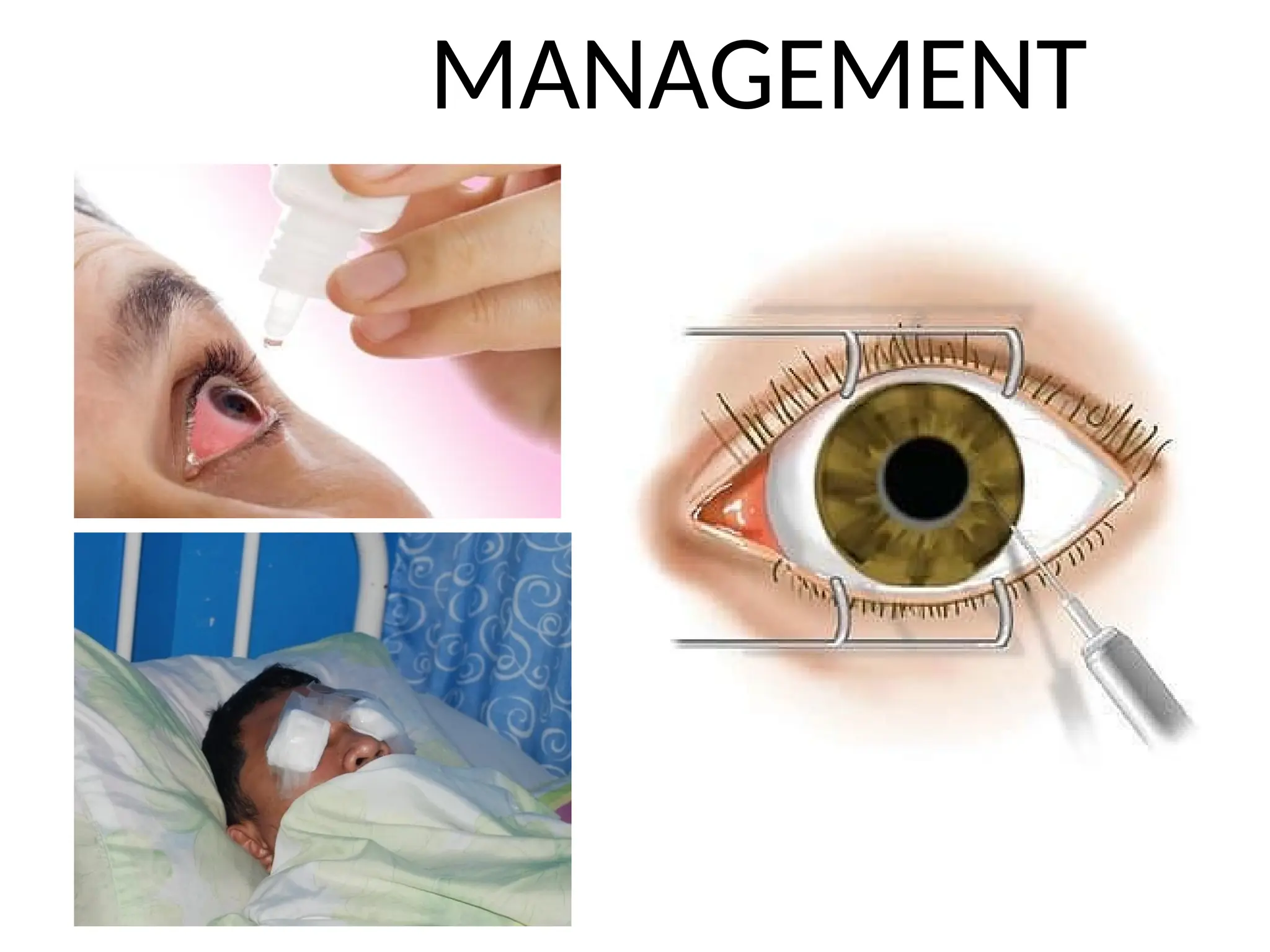 hypopyon vs ................hyphema.pptx