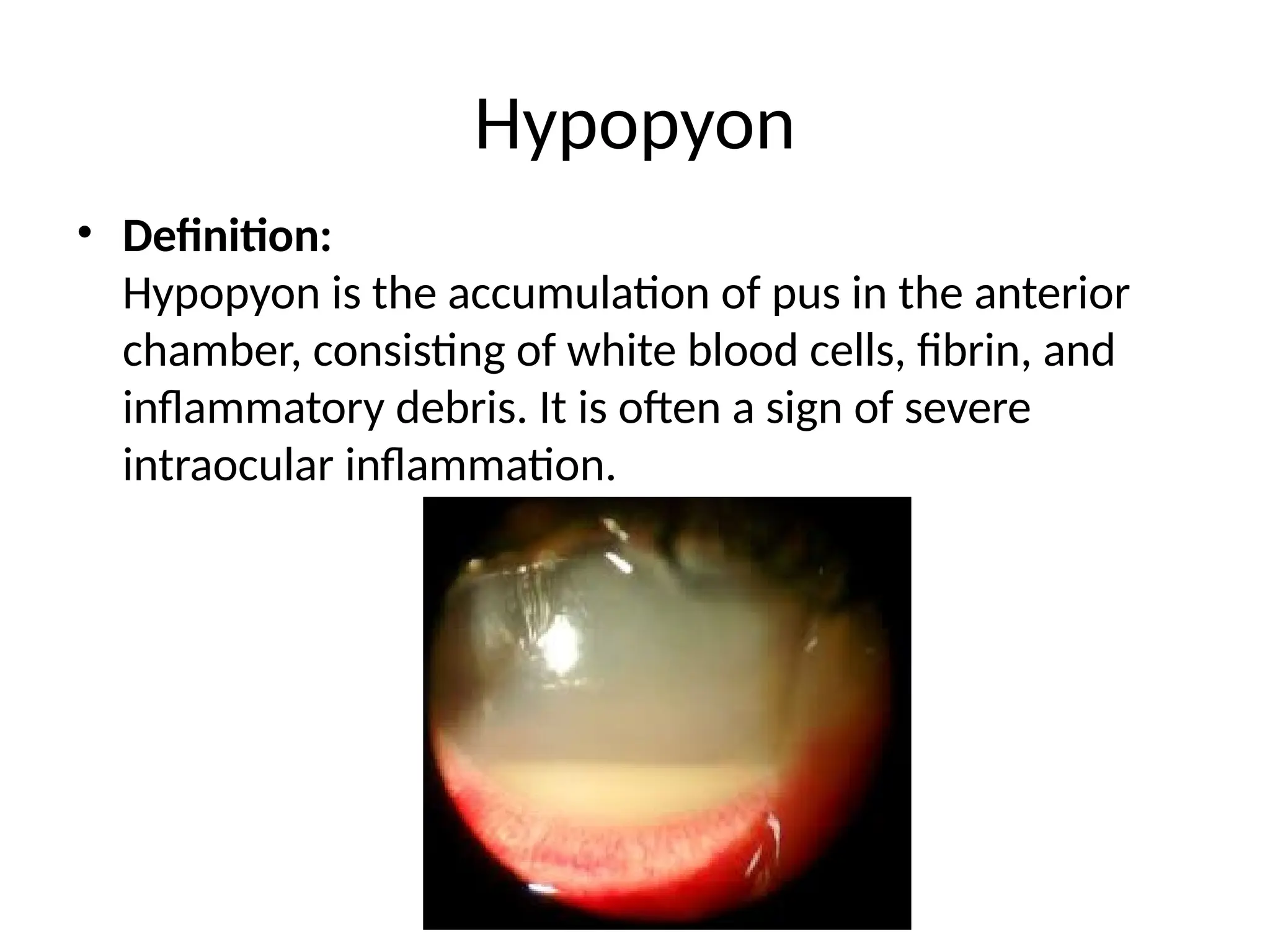 hypopyon vs ................hyphema.pptx