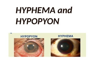 hypopyon vs ................hyphema.pptx