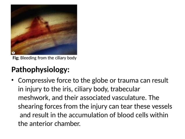 hypopyon vs ................hyphema.pptx