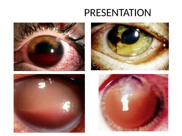 hypopyon vs ................hyphema.pptx