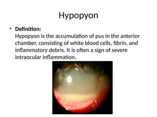 hypopyon vs ................hyphema.pptx