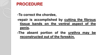 Hypospadial repair | PPTX