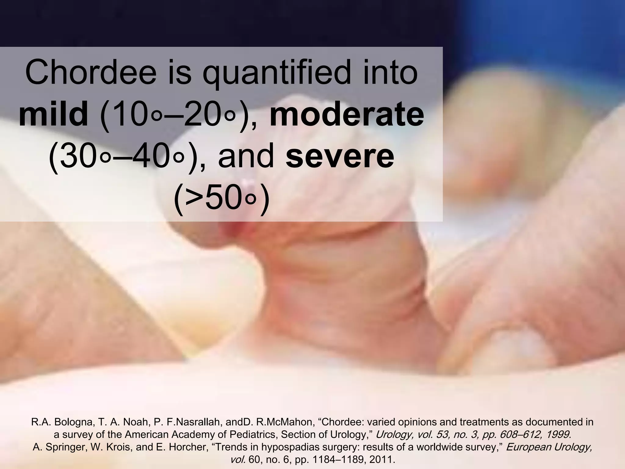 Hypospadia repair | PPTX
