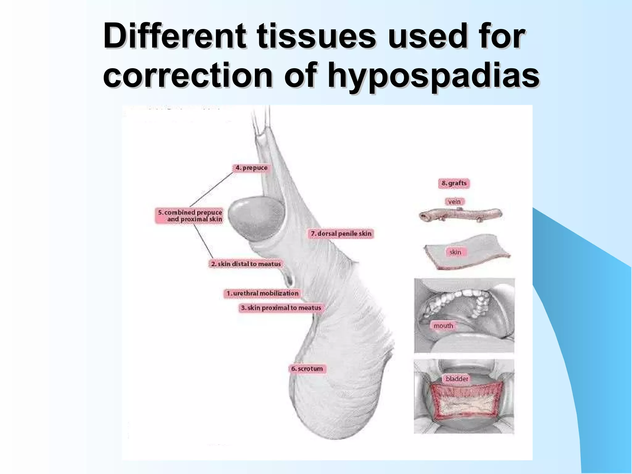 Hypospadias | PPT