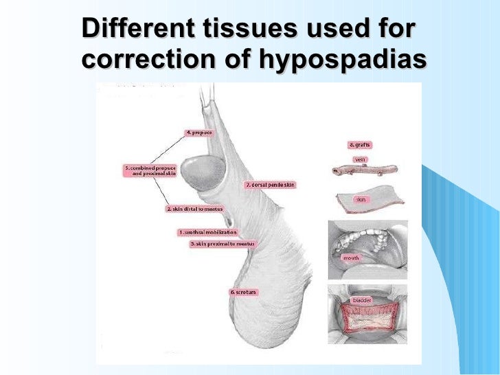Hypospadias