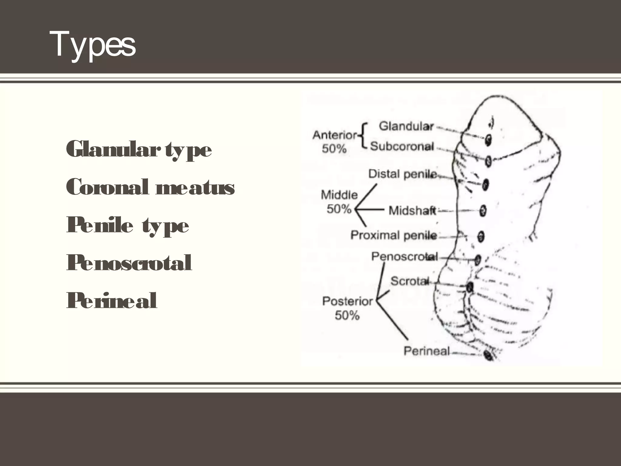Hypospadias | PPT