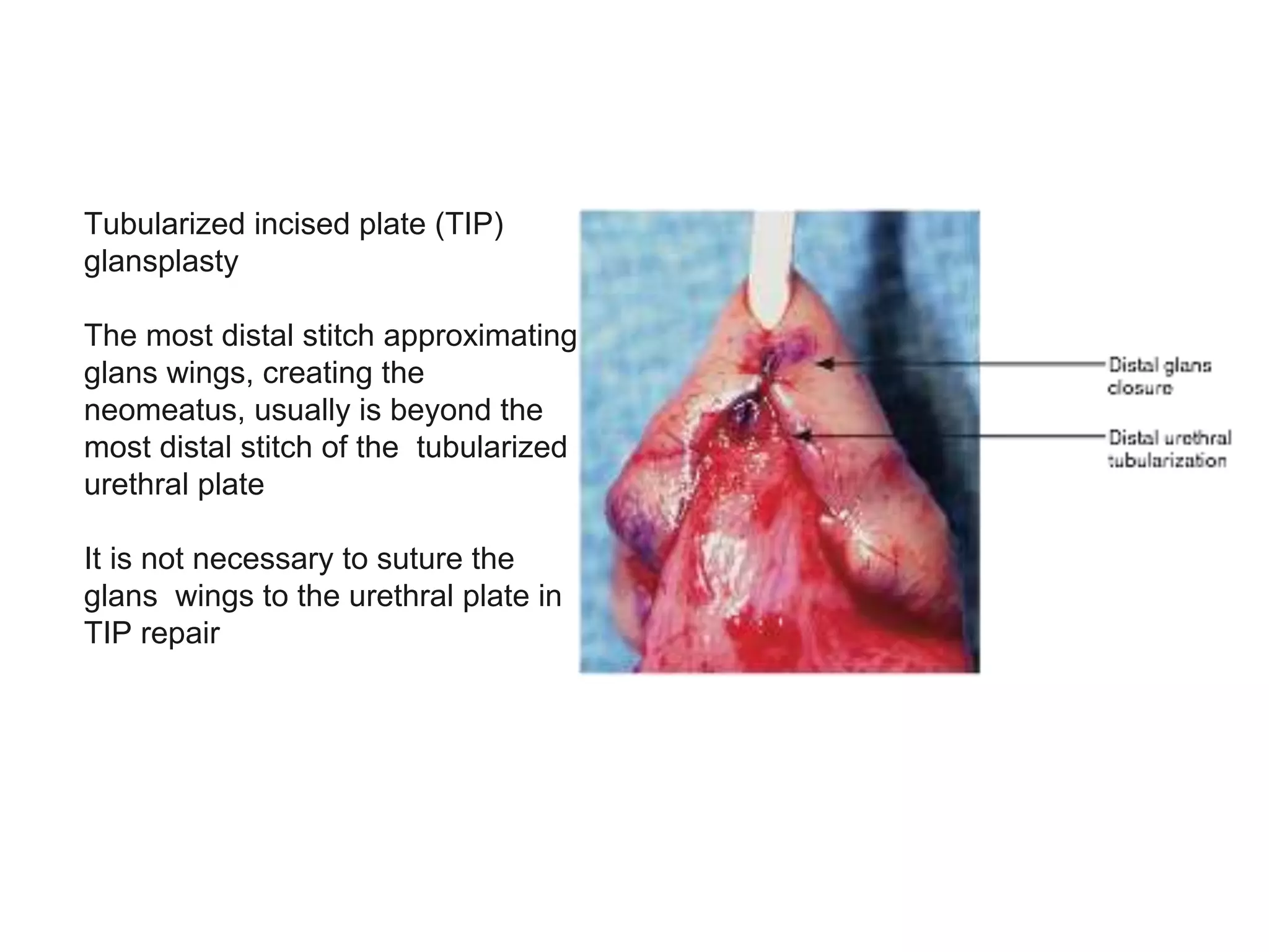 Hypospadias | PPTX