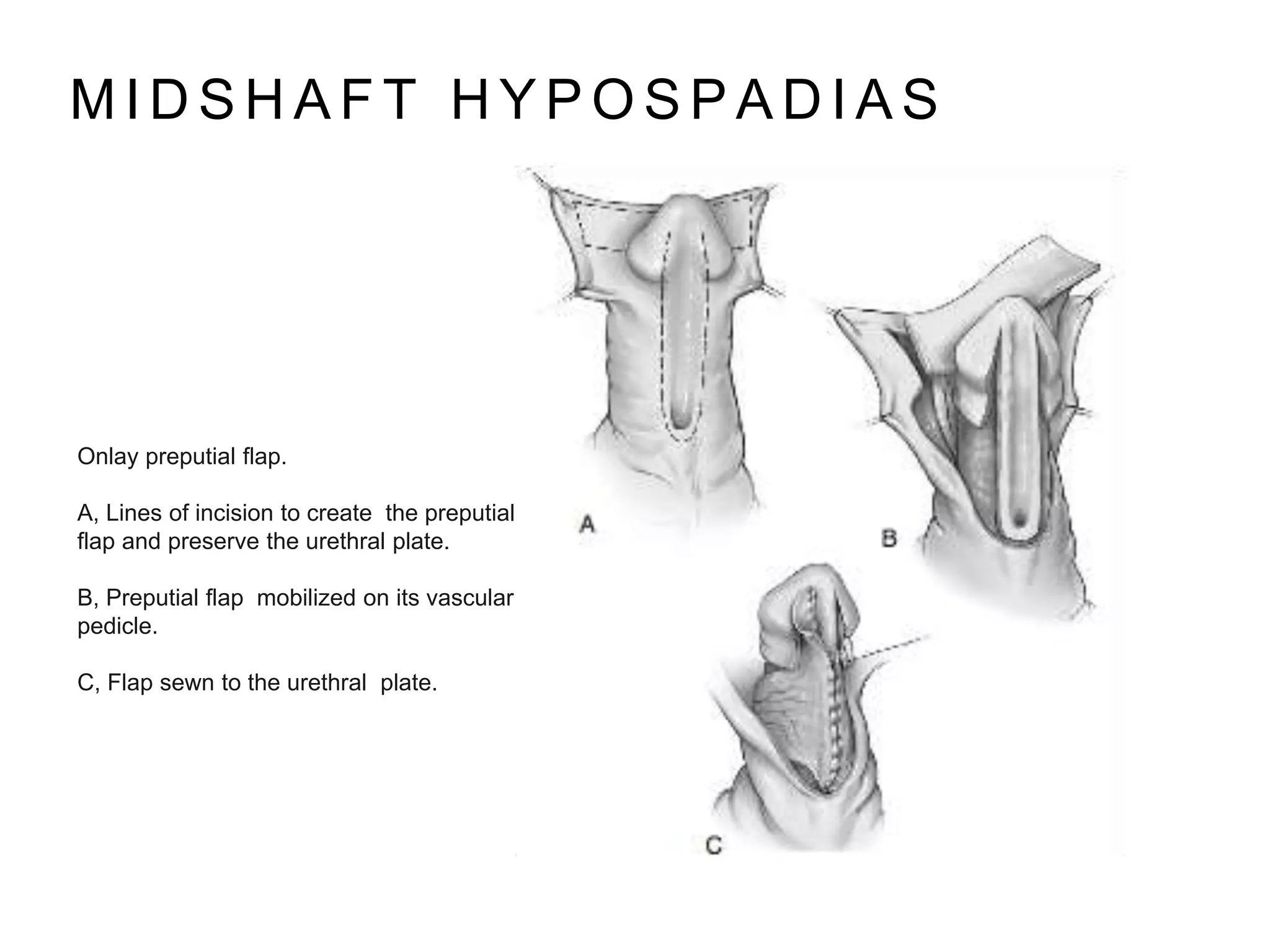 Hypospadias | PPTX
