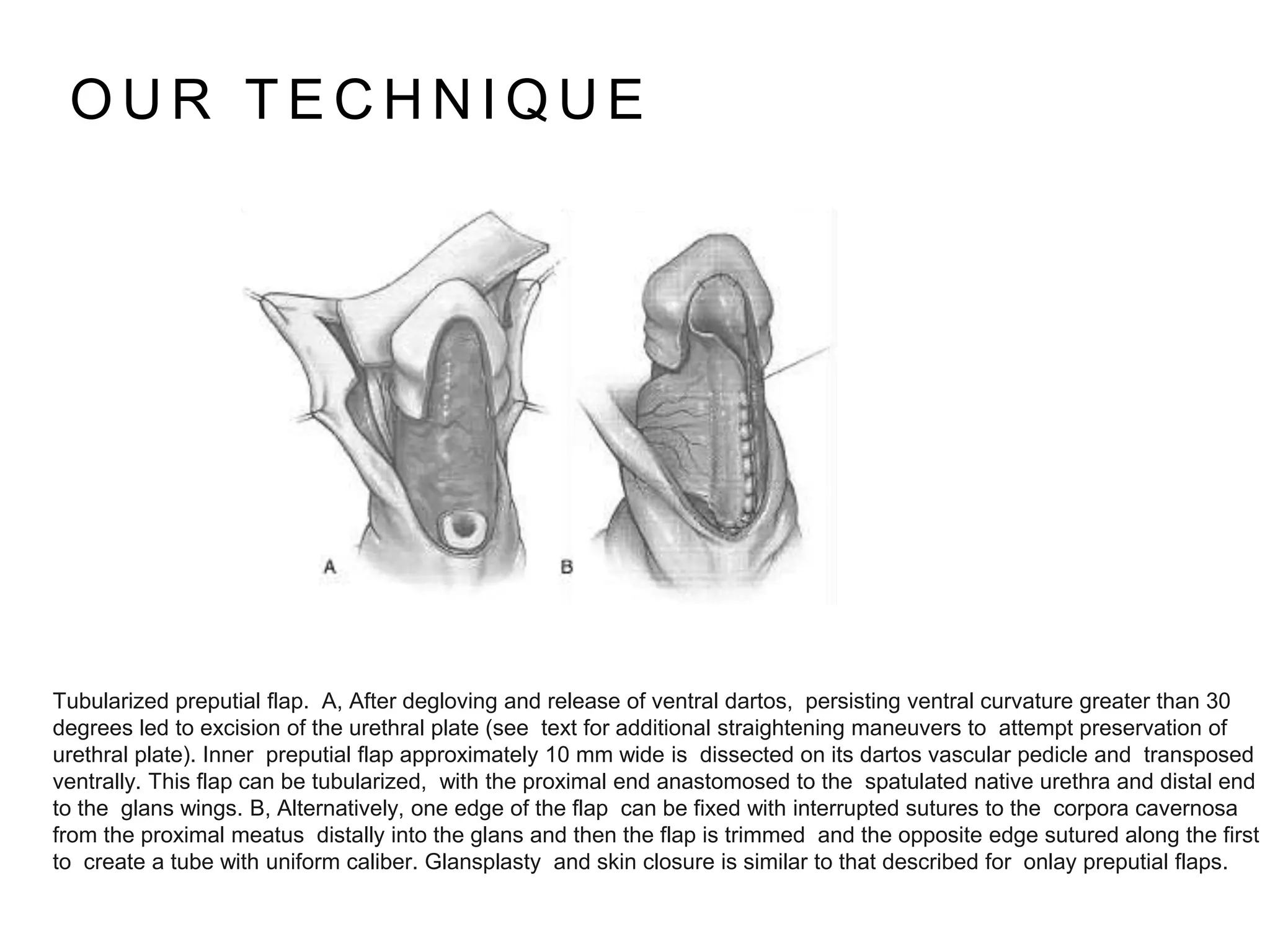 Hypospadias | PPTX