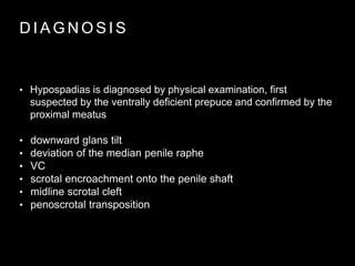 Hypospadias | PPTX