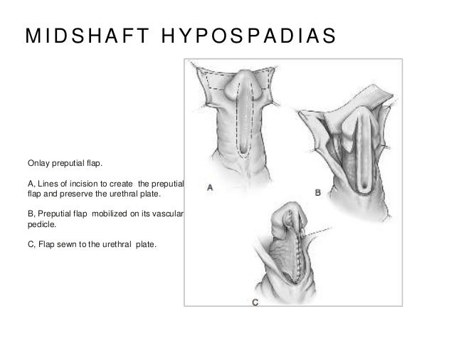 Hypospadias