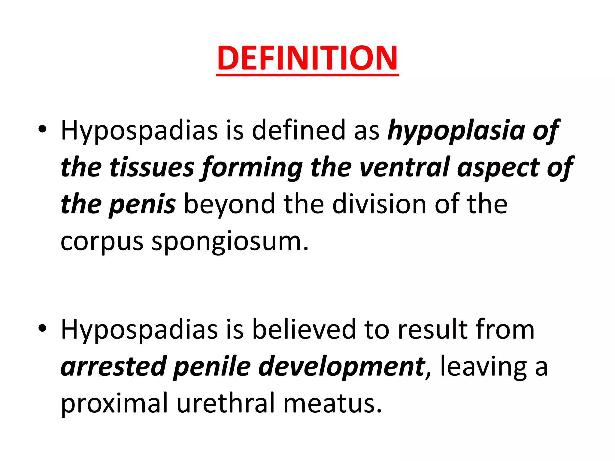 Hypospadias | PPTX