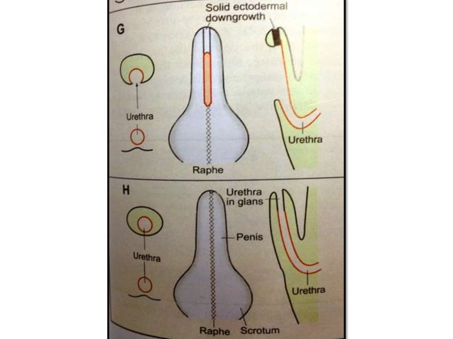 Hypospadias | PPTX