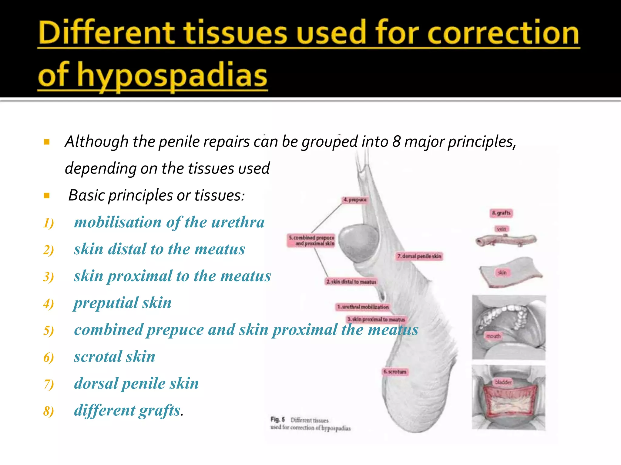 Mid Penile Hypospadias | PPTX | Sexual Conditions | Sexual Health
