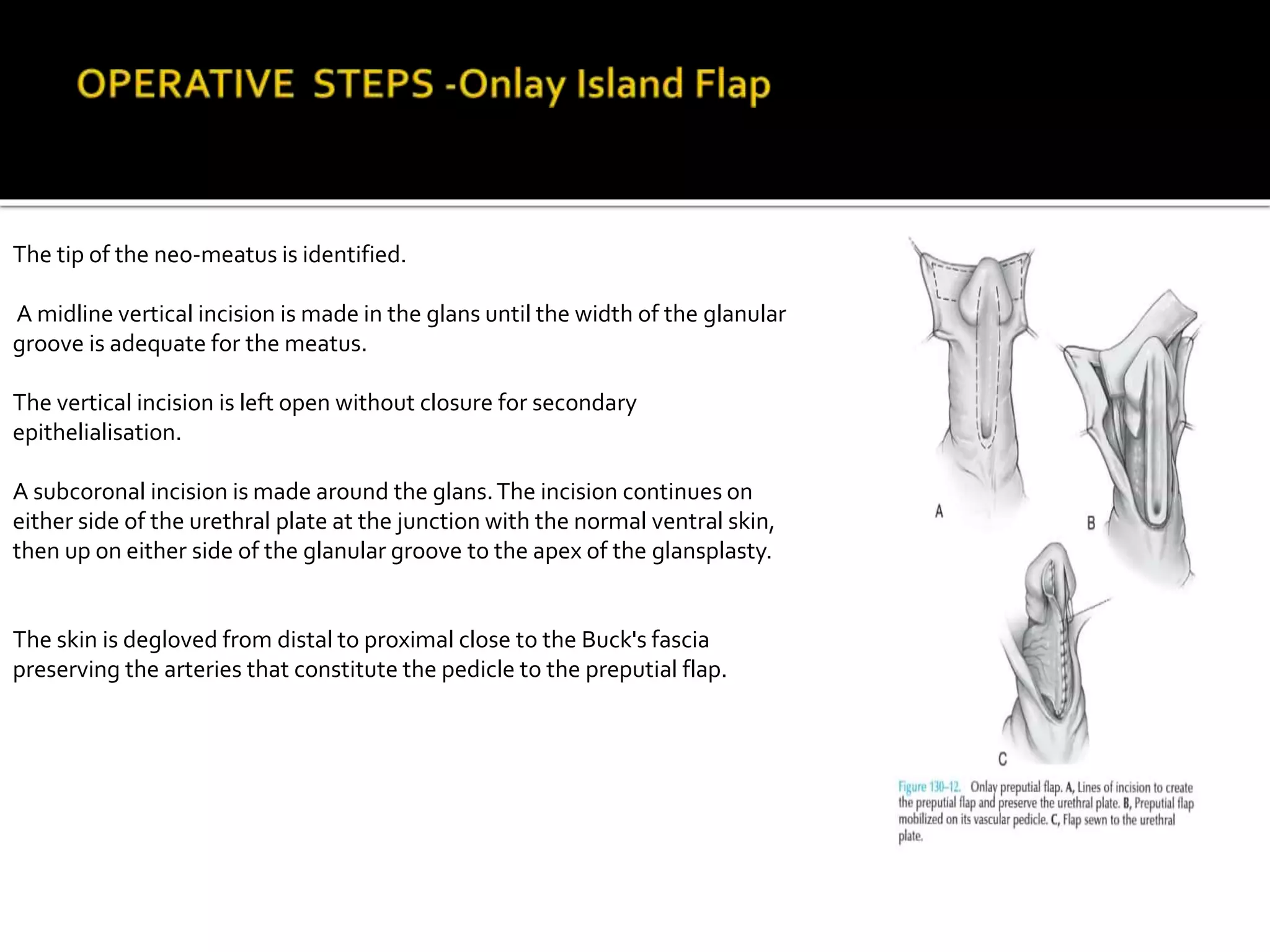 Mid Penile Hypospadias | PPTX | Sexual Conditions | Sexual Health