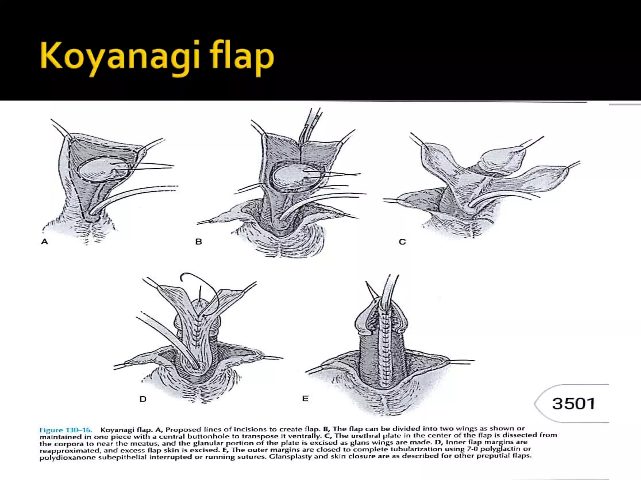 Mid Penile Hypospadias | PPTX | Sexual Conditions | Sexual Health