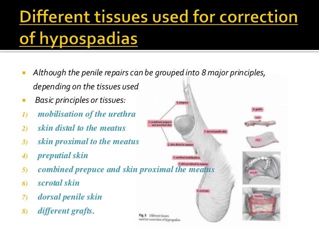 Mid Penile Hypospadias