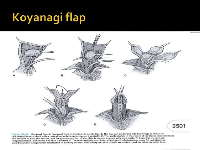Mid Penile Hypospadias