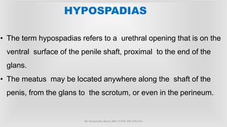 HYPOSPADIAS (CONGENITAL ANOMALY OF GENITOURINARY SYSTEM) | PPTX