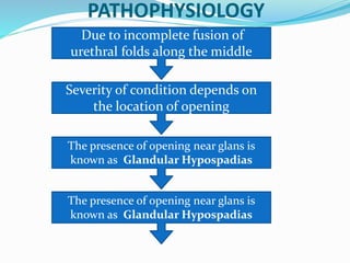 Hypospadias | PPTX