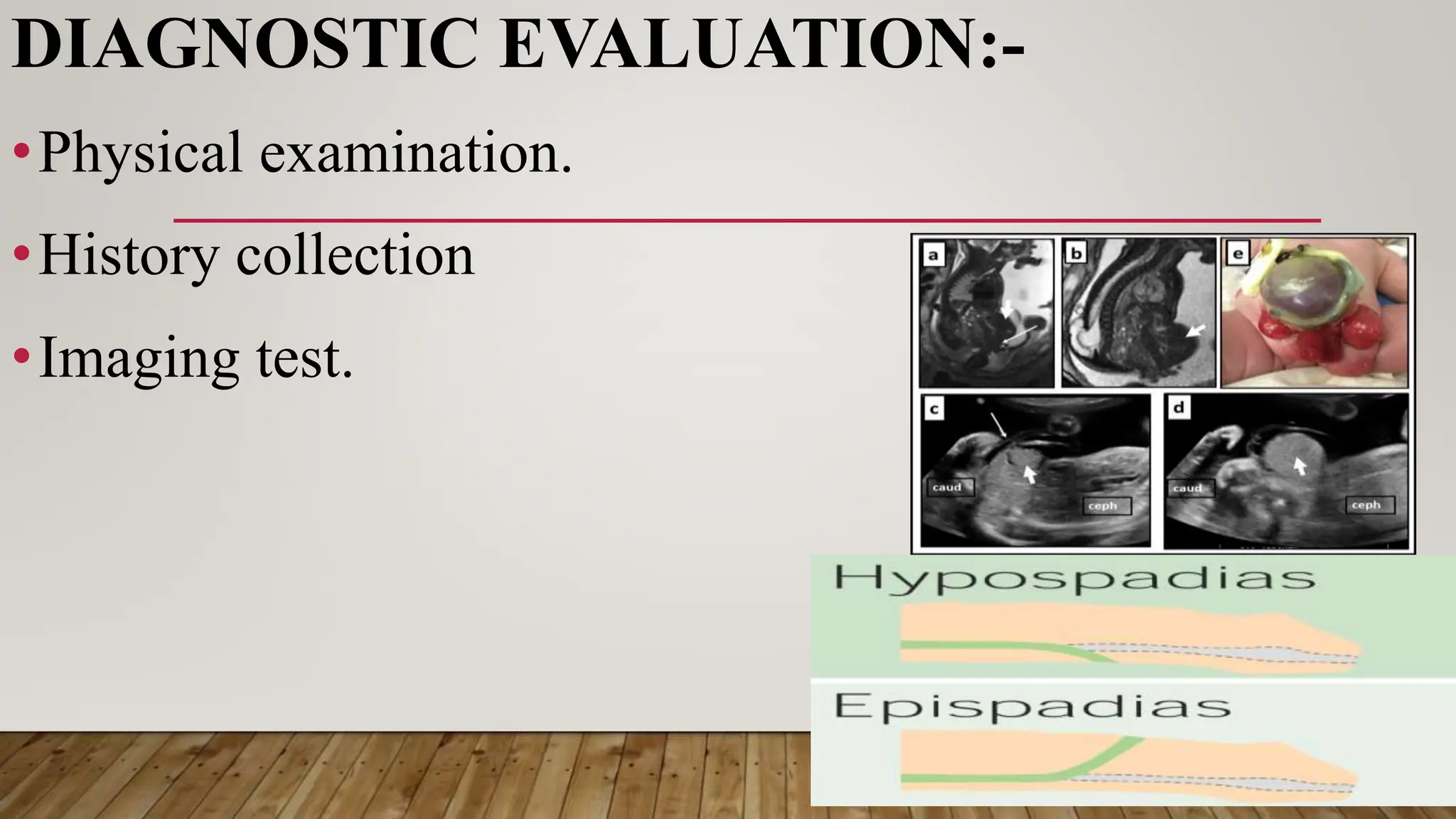Hypospadias.pptx
