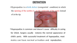 hypospadias/hypospadias in children.pptx
